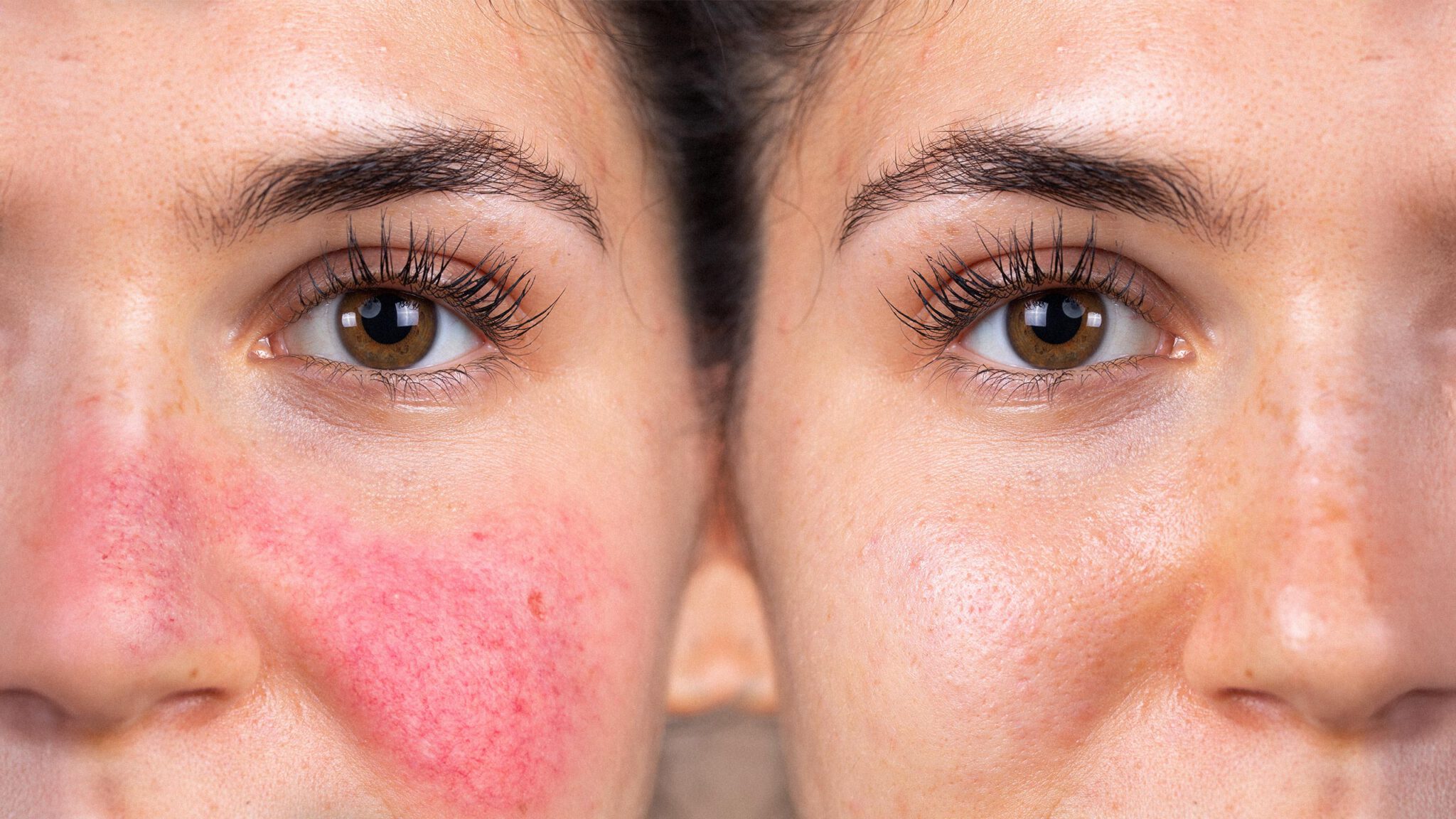 Laser Genesis | Dermatology Clinics Australia