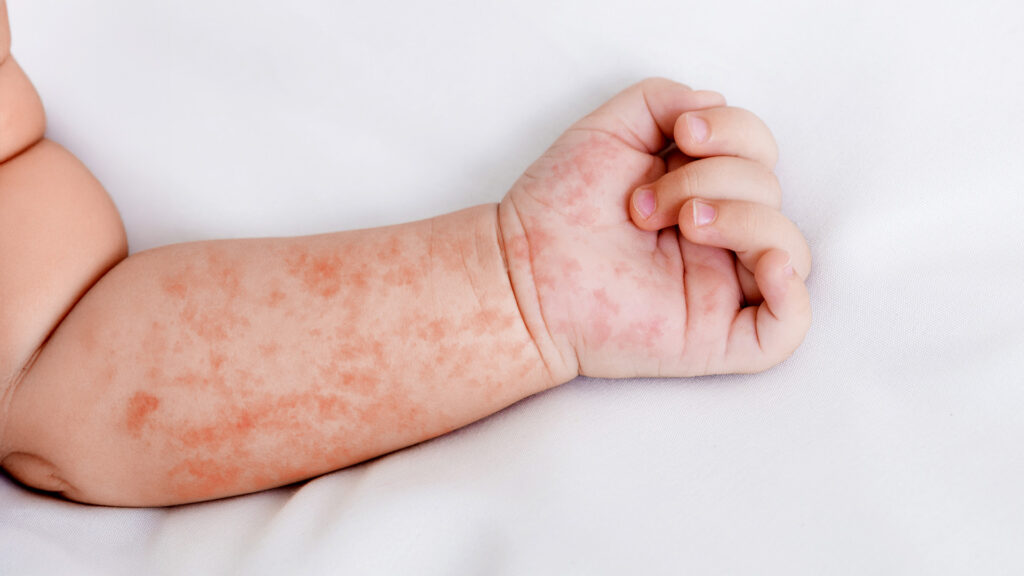 Rashes | Dermatology Clinics Australia