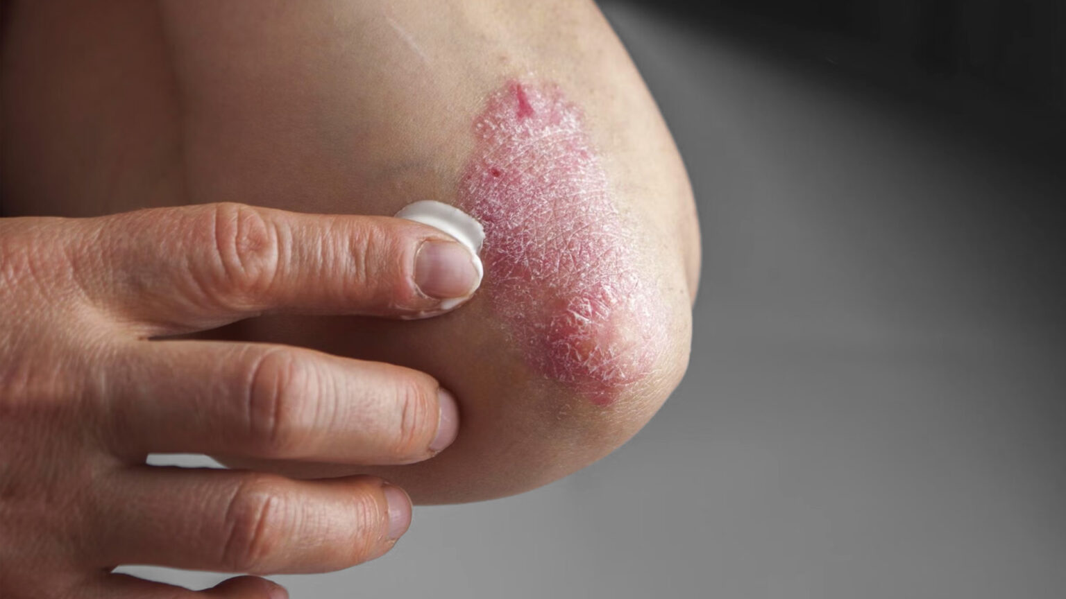 Psoriasis | Dermatology Clinics Australia