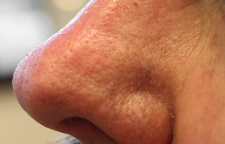 Rhinophyma | Dermatology Clinics Australia