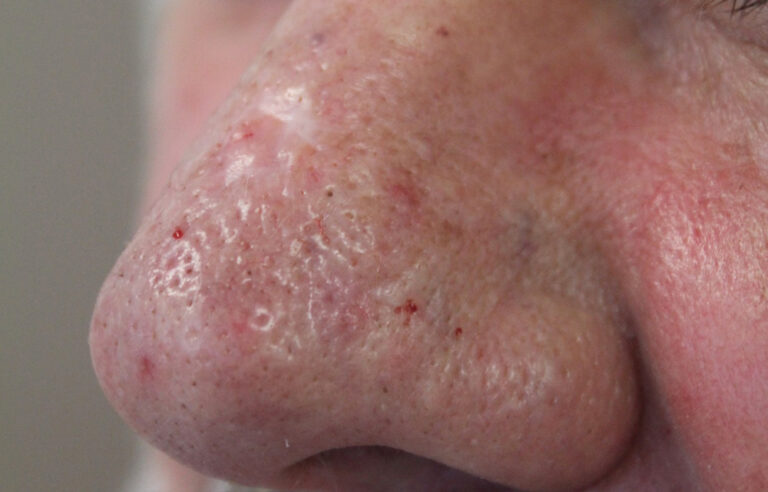 Rhinophyma | Dermatology Clinics Australia